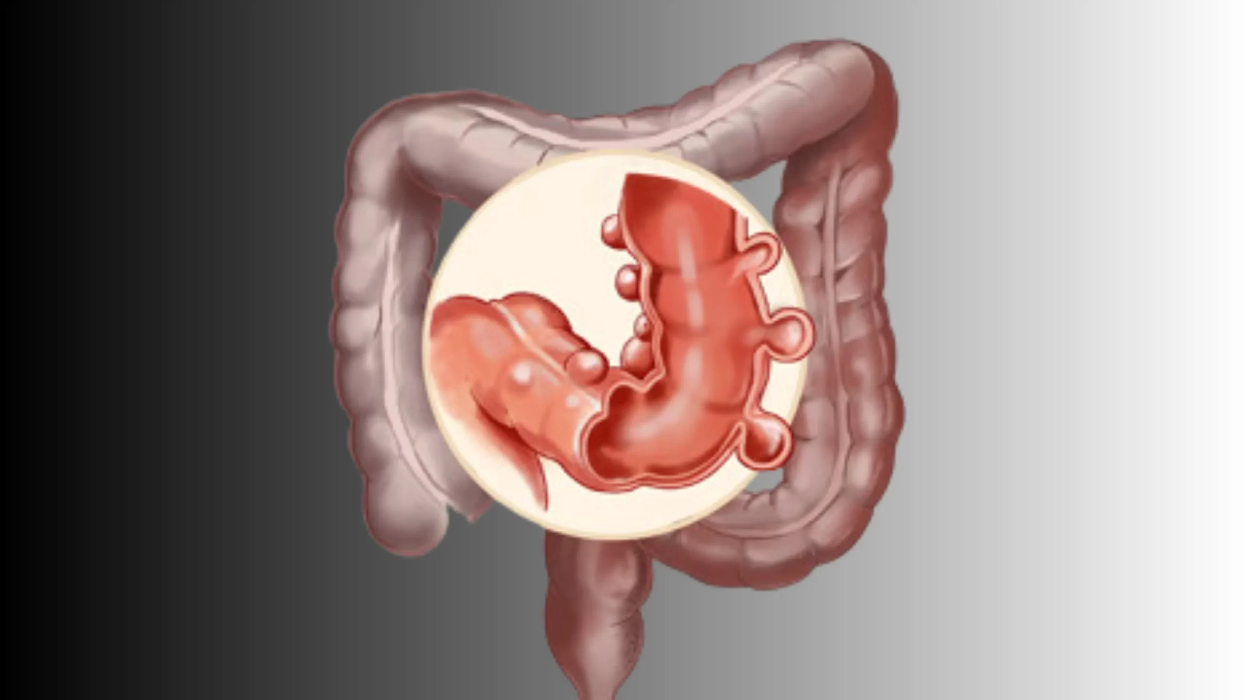 Enfermedad diverticular del colon: síntomas, diagnóstico y tratamiento ...